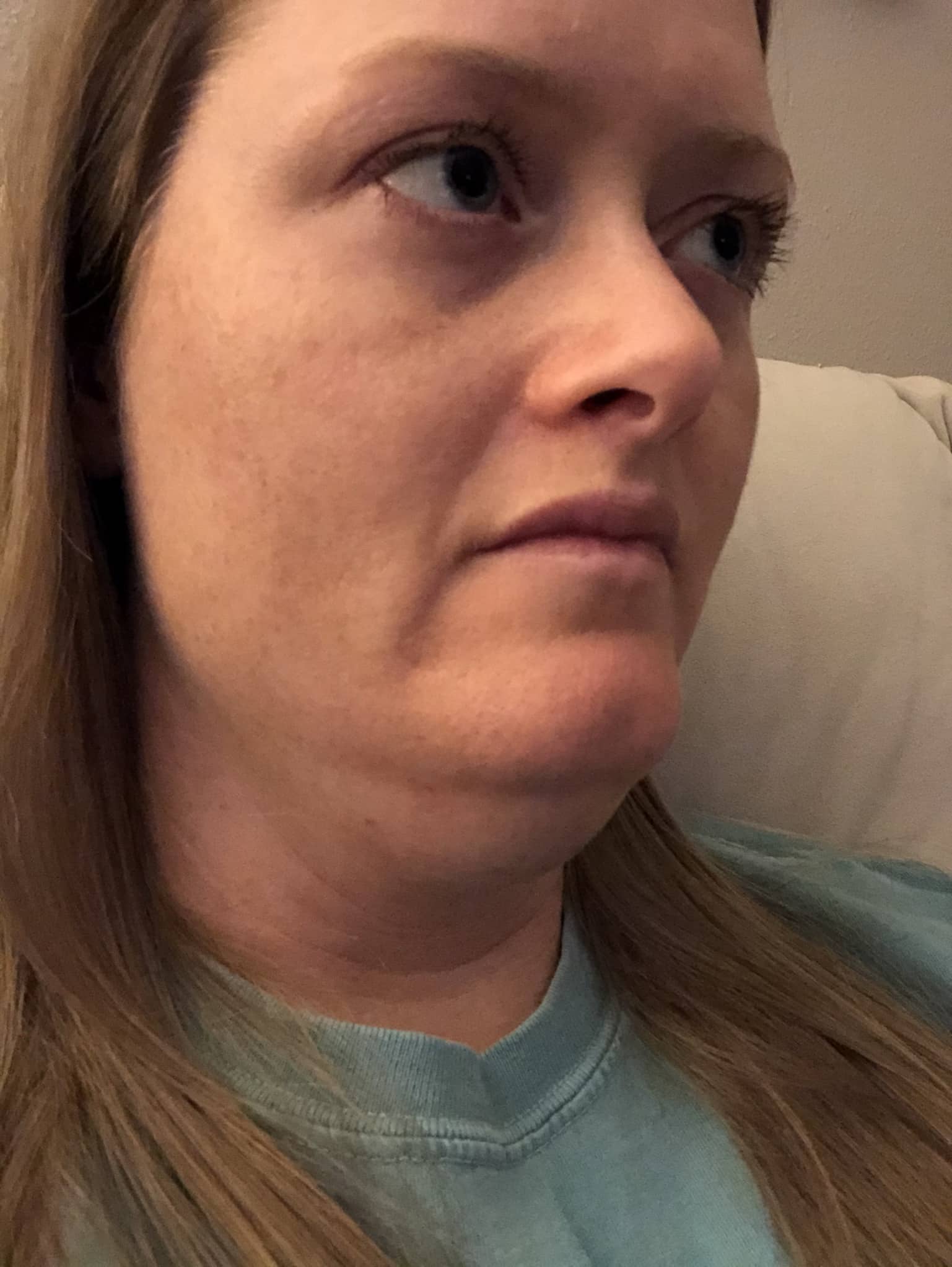 My Kybella Before and After - How to Get Rid of Double Chin